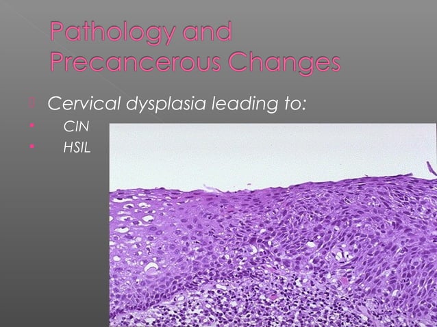 Cancer of cervix | PPT | Cancer | Diseases and Conditions