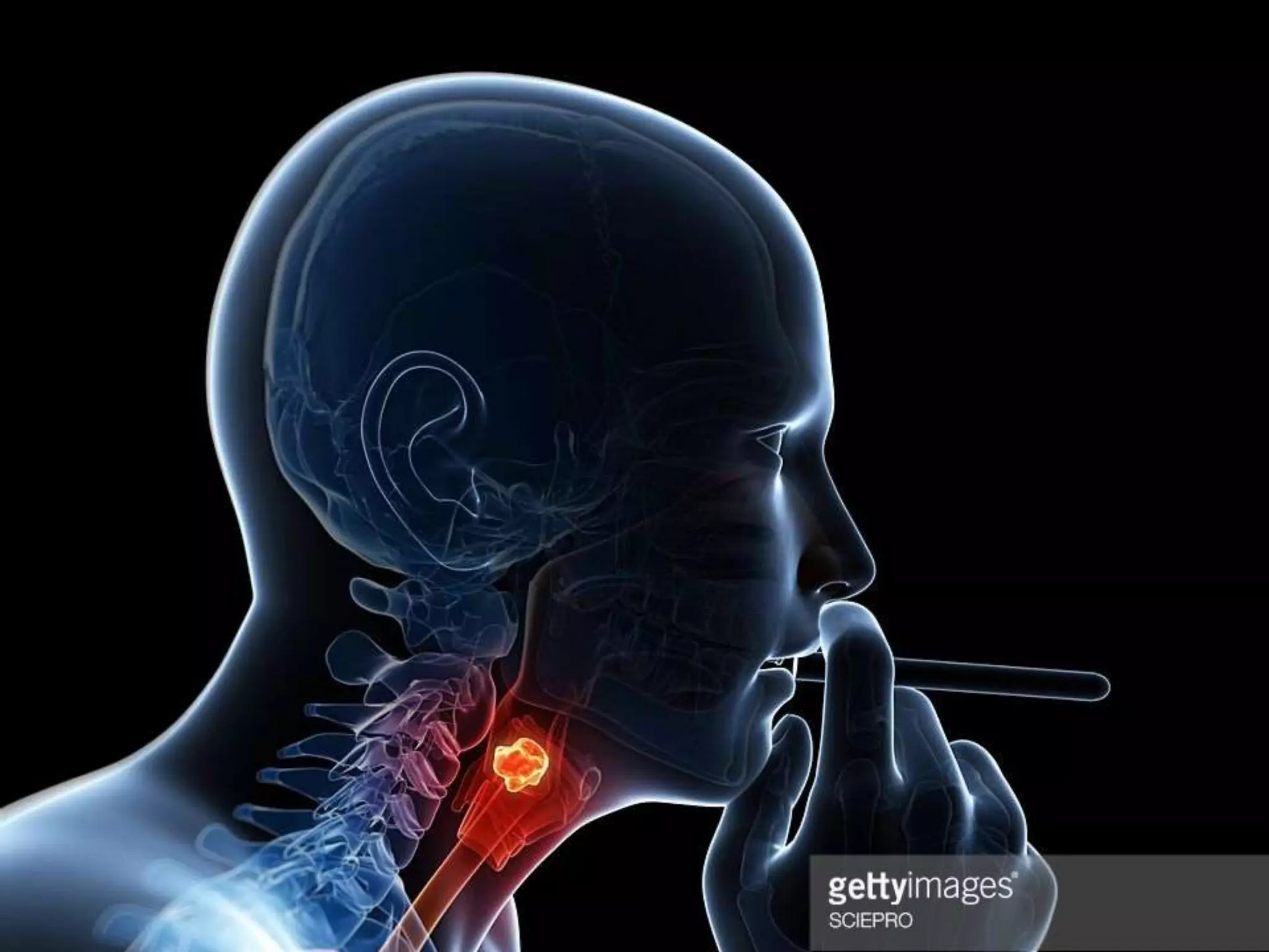 Cancer of larynx | PPTX