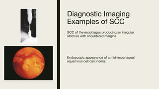 Cancer of the Esophagus-kkkkkkkkkkkk1.pdf
