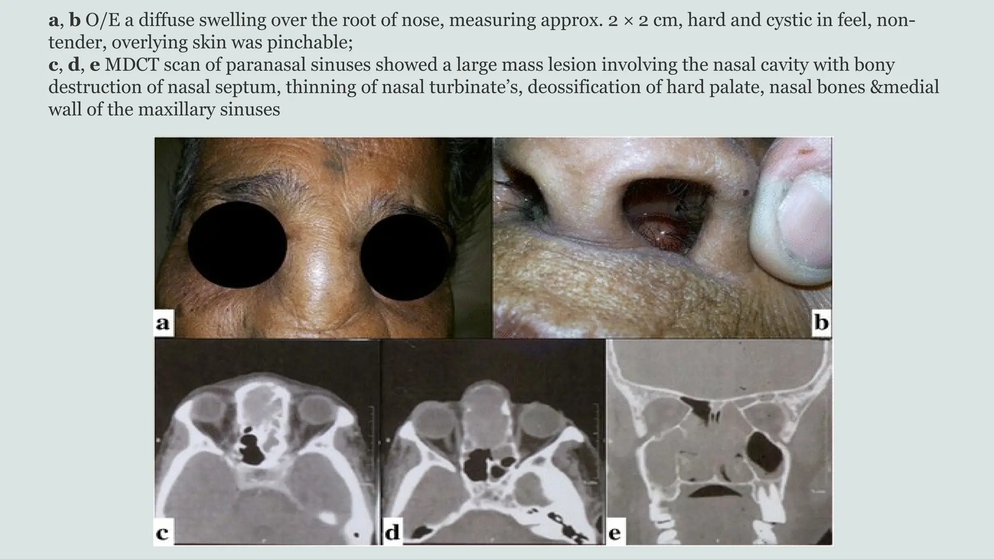 Cancer of the Nasal Cavity and paranasal sinus .pptx