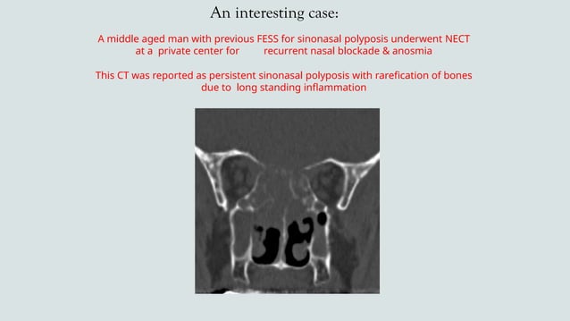 Cancer of the Nasal Cavity and paranasal sinus .pptx