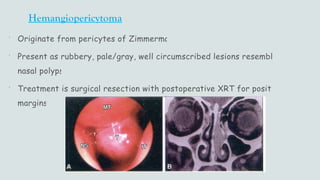 Cancer of the Nasal Cavity and paranasal sinus .pptx