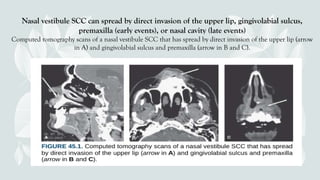 Cancer of the Nasal Cavity.pptx radiation oncology | PPTX