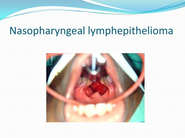 Cancer of the nasopharynx | PPT