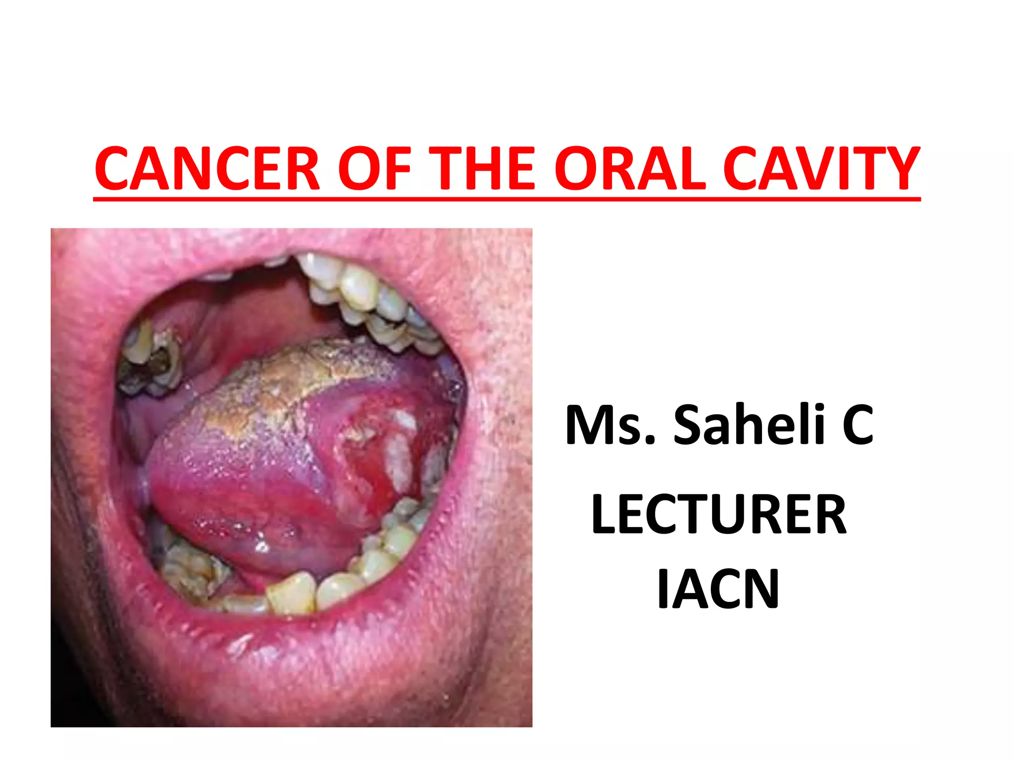 Cancer of the oral cavity | PDF