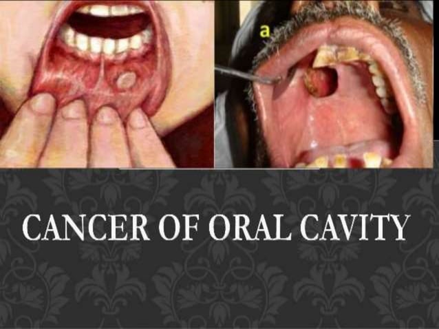 Cancer of the oral cavity | PDF | Dental Health | Diseases and Conditions