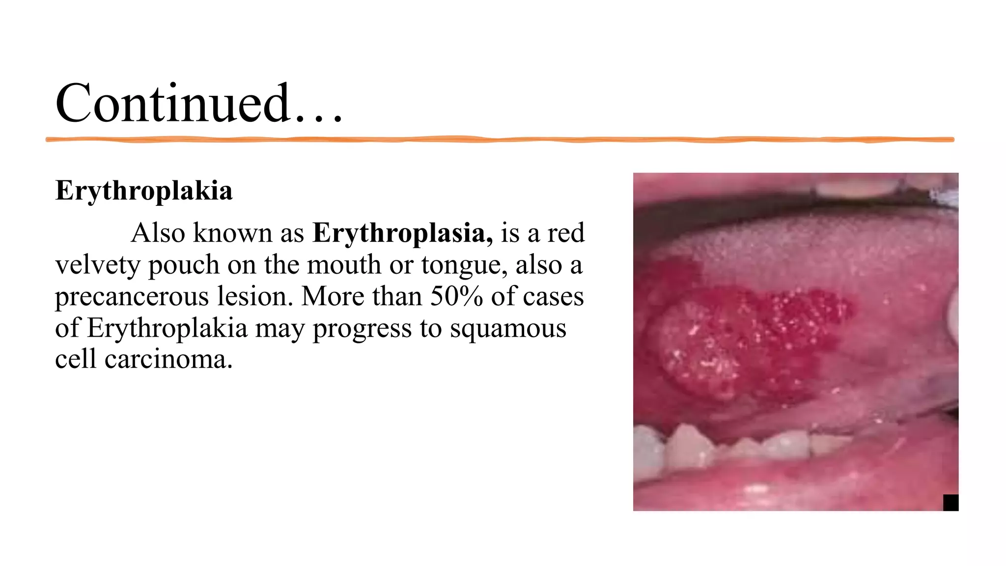 Cancer Of The Oral Cavity - Rahul SIR | PPTX