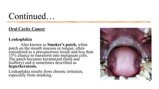 Cancer Of The Oral Cavity - Rahul SIR | PPTX