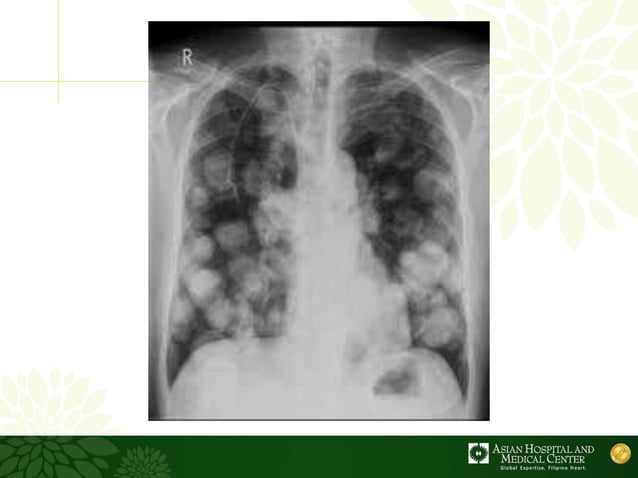 Cancer of unknown primary: Knowing the unknown | PPTX | Endocrine and ...