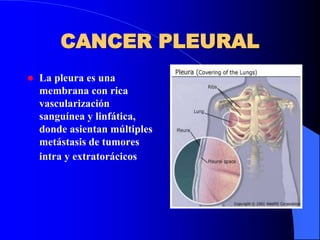 Cancer pleural | PPT