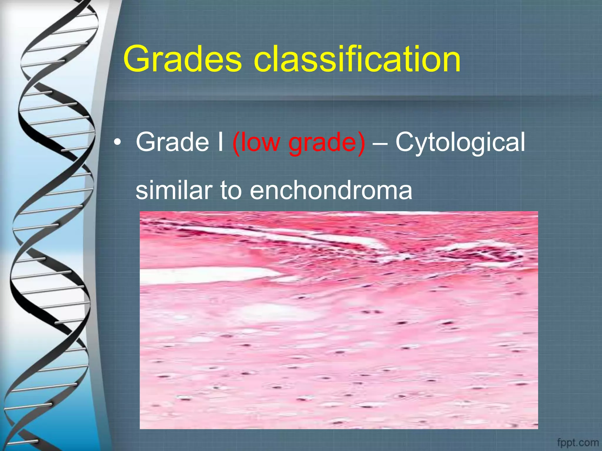 chondrosarcoma | PPT