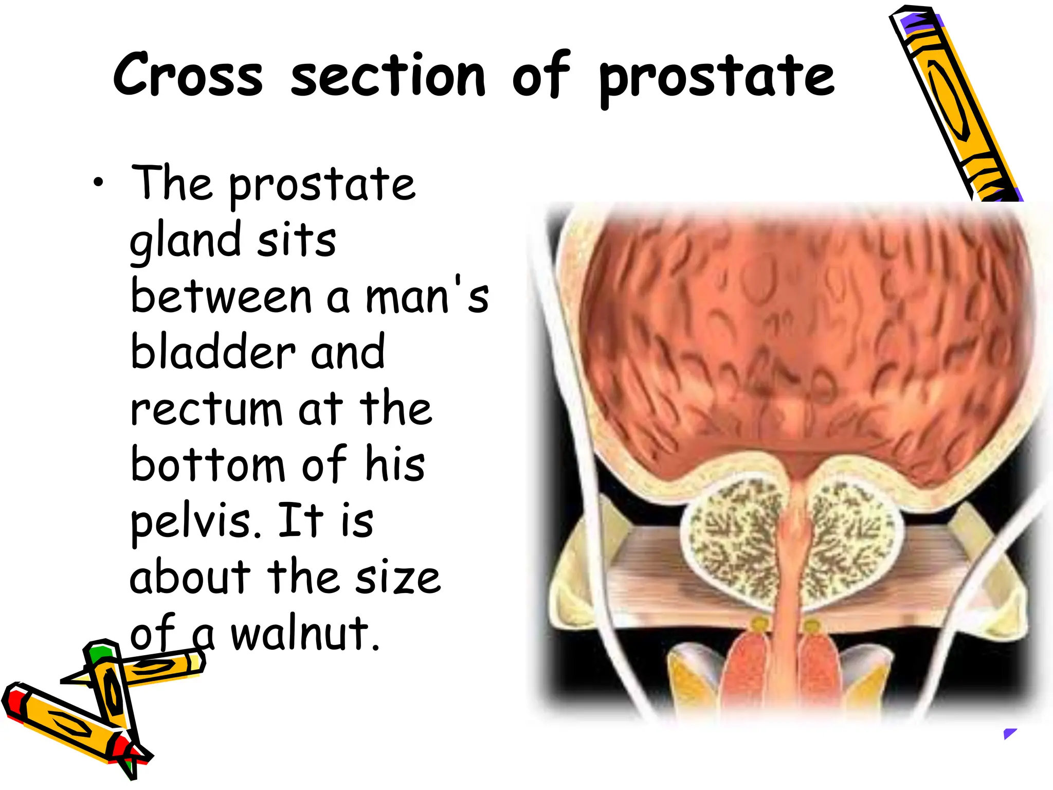 Cancer of Prostate gland (Prostate Hyperplasia) | PPT