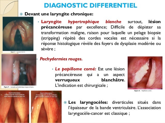 Cancers du larynx