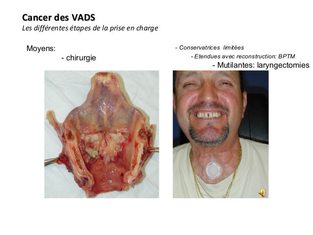 Cancers vads ide 3ieme année