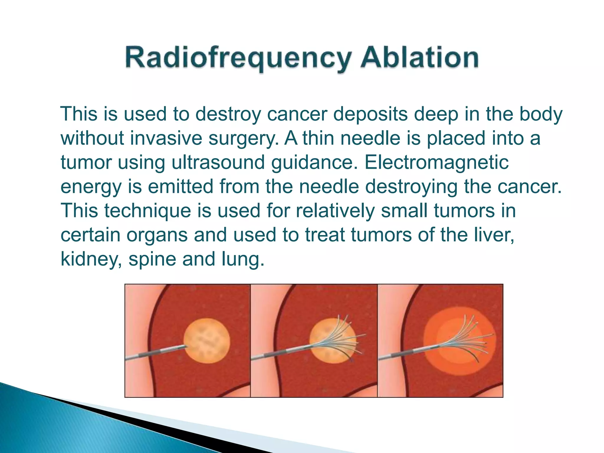 Cancer treatment and interventional oncology | PPTX