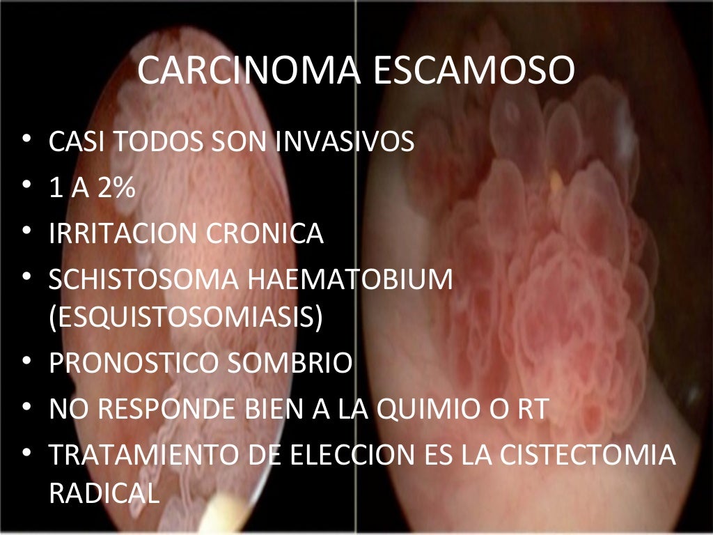 Cancer vesical
