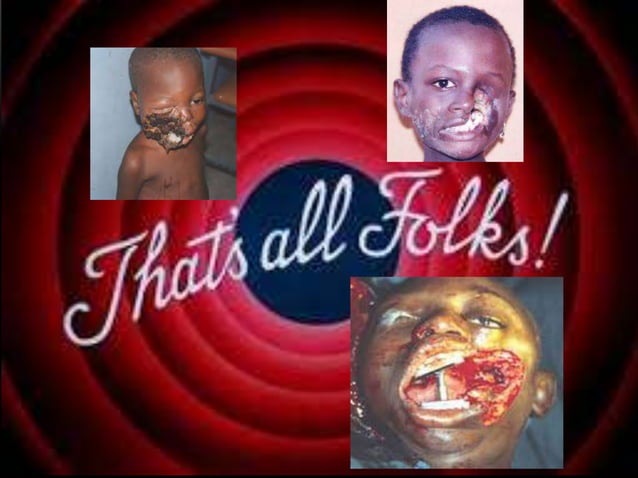 Cancrum oris or noma | PPTX