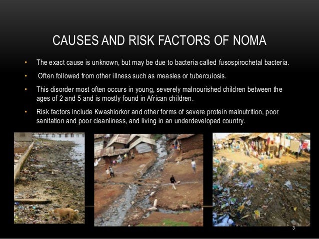 Cancrum oris or noma