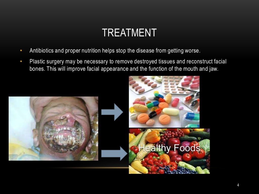 Cancrum oris or noma