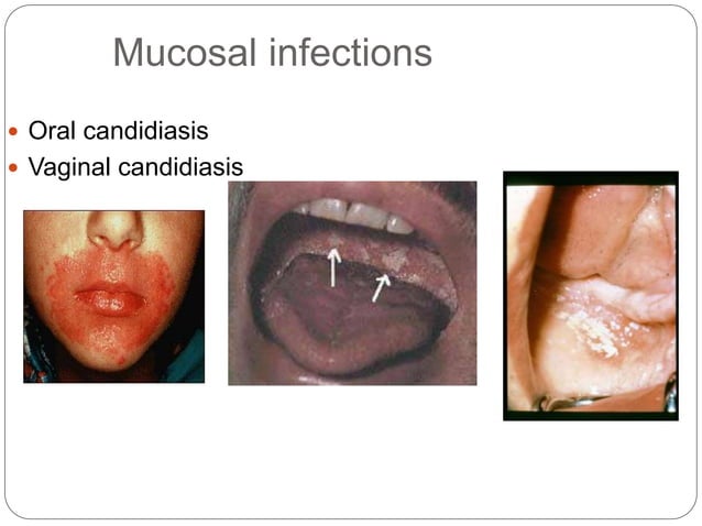 Candida | PPTX | Skin and Dermatology | Diseases and Conditions