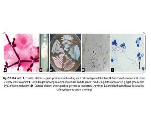 Candida | PPTX | Skin and Dermatology | Diseases and Conditions
