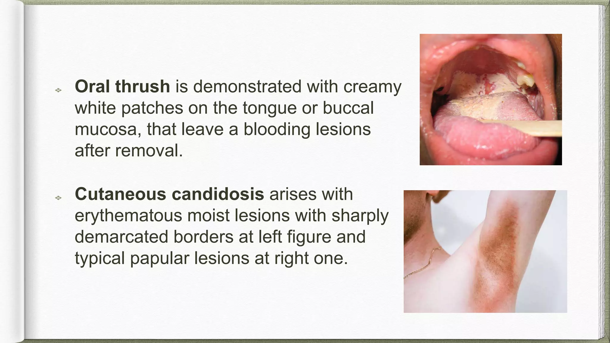 Candida.pptx