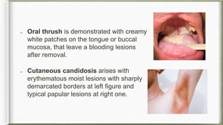 Candida.pptx