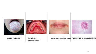 Candida albicans - opportunistic mycoses.pptx