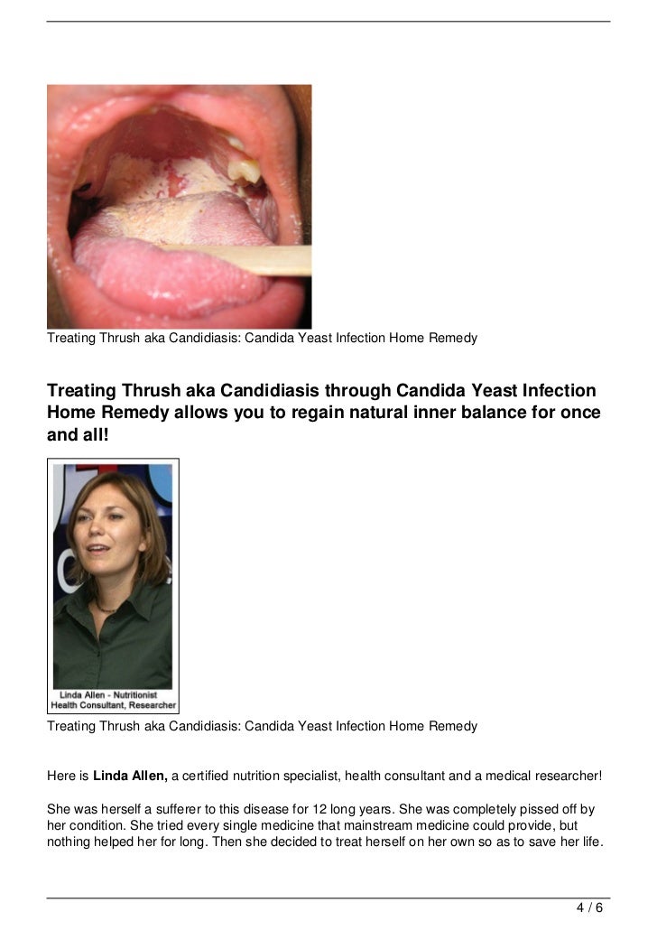 Candida Yeast Infection Home Remedy: Treating Thrush aka Candidiasis