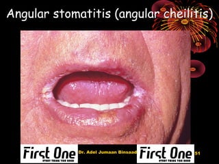 Angular Cheilitis Hiv