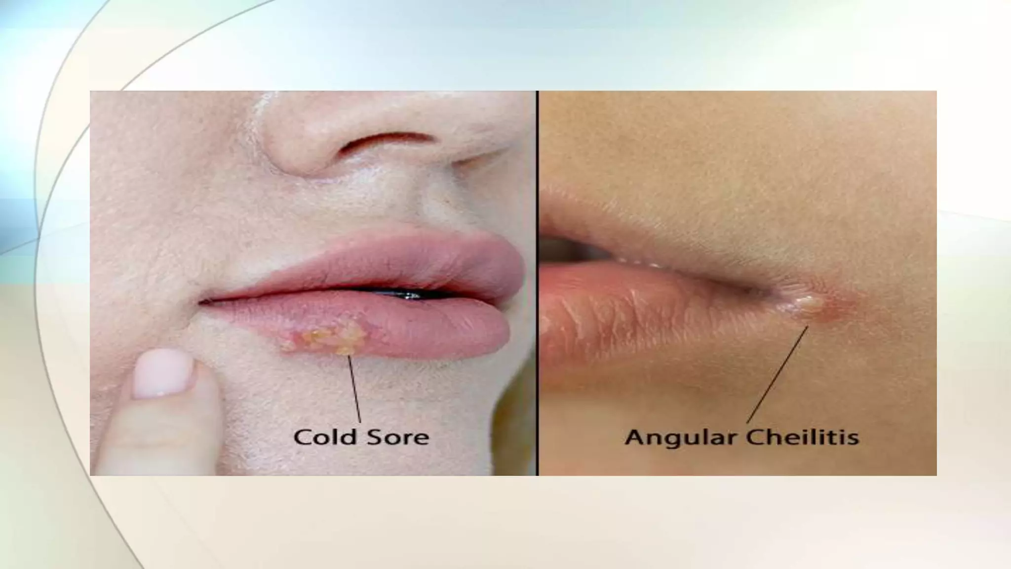 candidal infection.pptx
