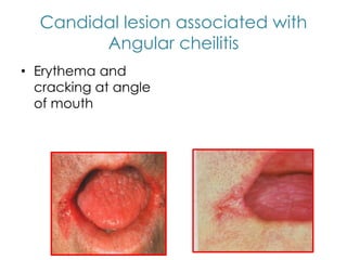 Candidal infections of the oral cavity | PPTX