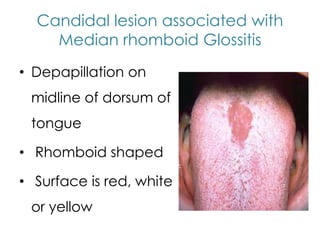 Candidal infections of the oral cavity | PPT