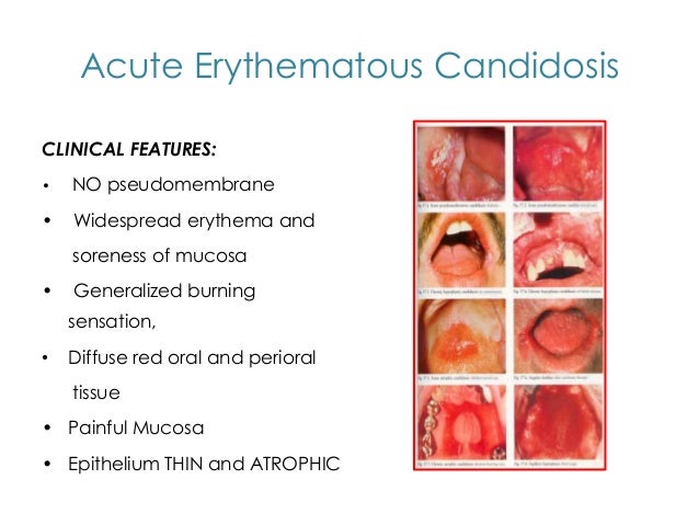 Candidal infections of the oral cavity