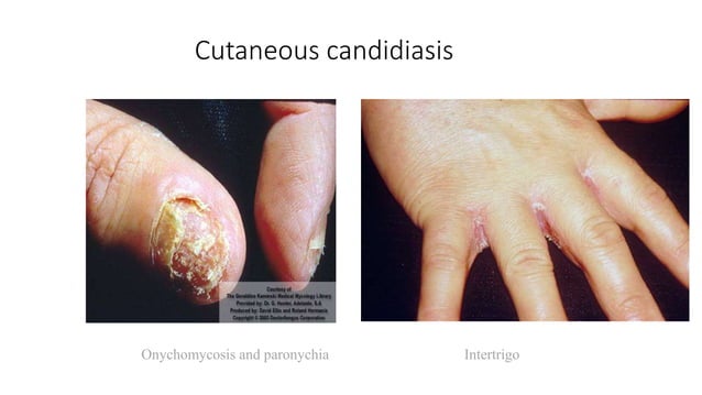 Candida pathogen.pptx | Skin and Dermatology | Diseases and Conditions