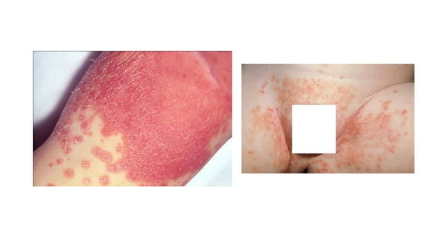 Candida pathogen.pptx | Skin and Dermatology | Diseases and Conditions