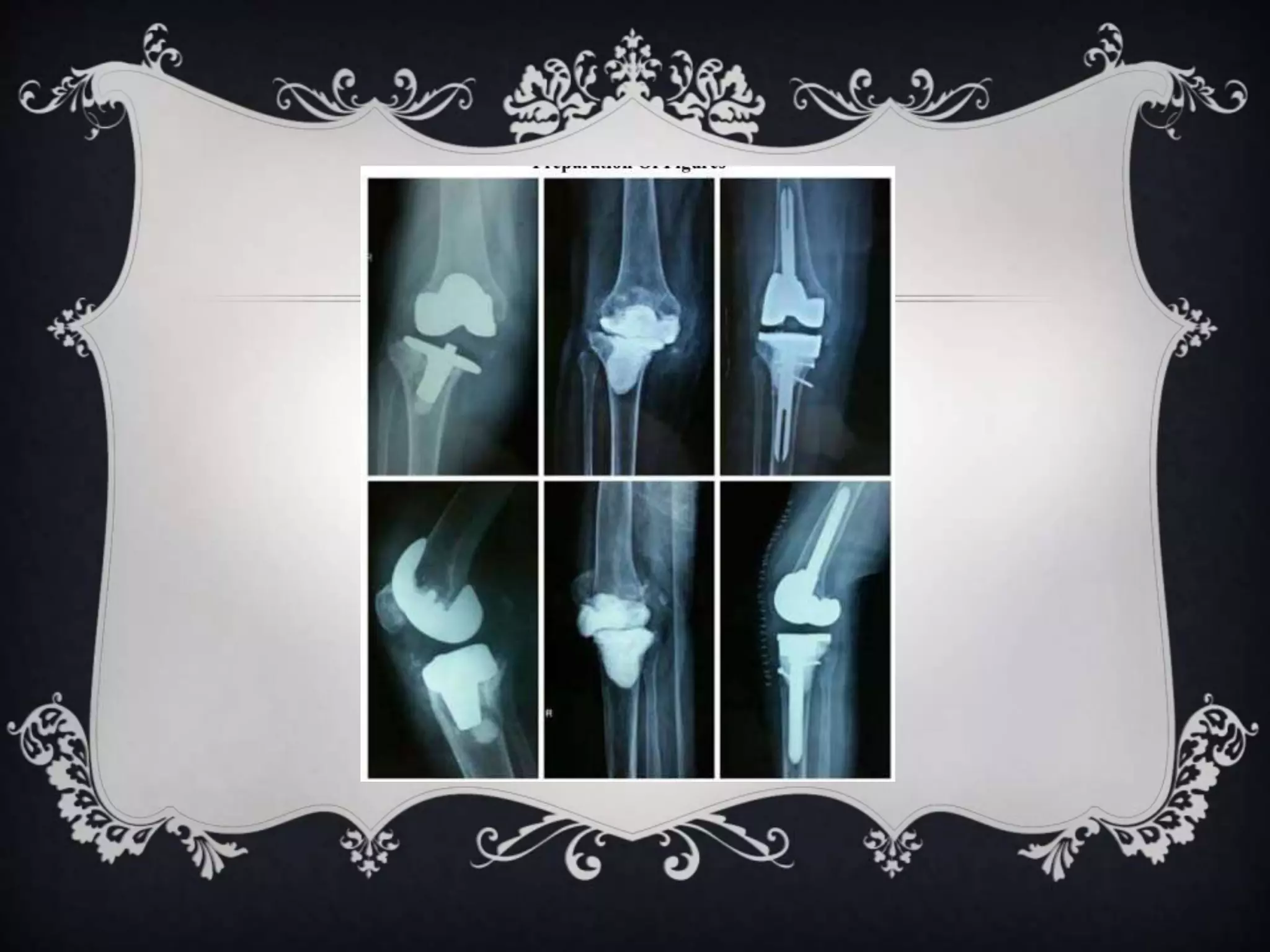 Fungal Periprosthetic Joint Infection By Candida Glabrata – Two Stage ...