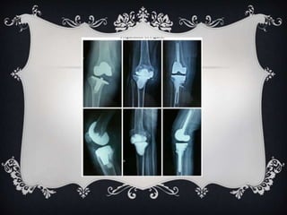 Fungal Periprosthetic Joint Infection By Candida Glabrata – Two Stage ...