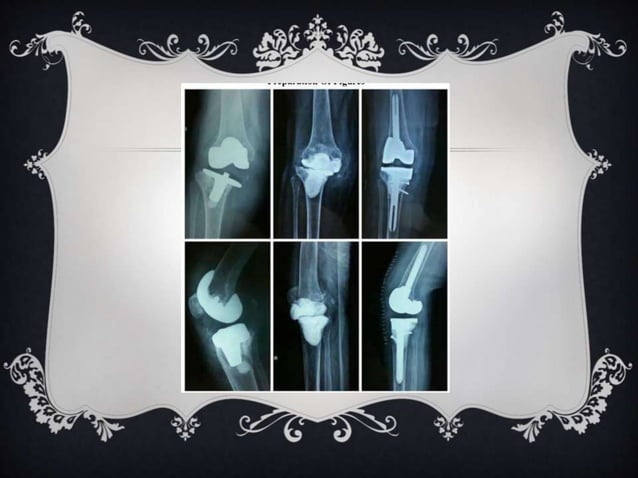 Fungal Periprosthetic Joint Infection By Candida Glabrata – Two Stage ...