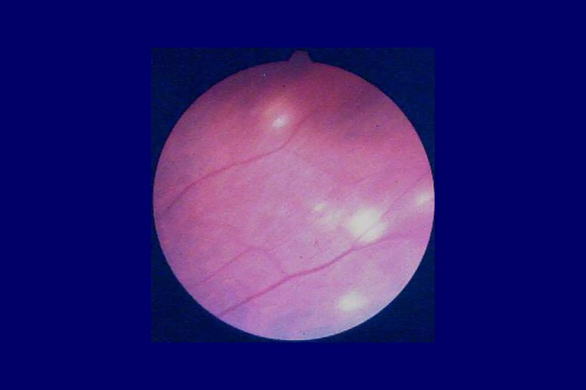 Candida Endophthalmitis | PPT