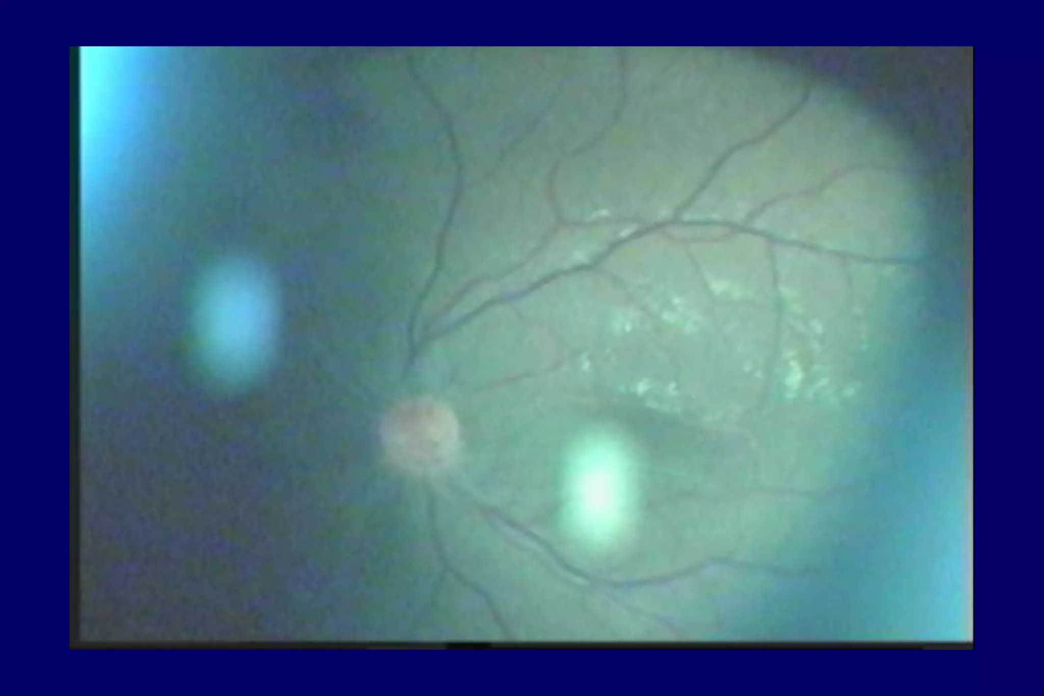 Candida Endophthalmitis | PPT