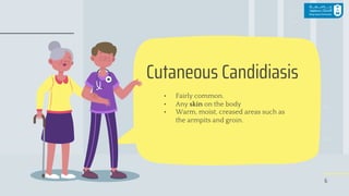 Candidasis infection | PDF