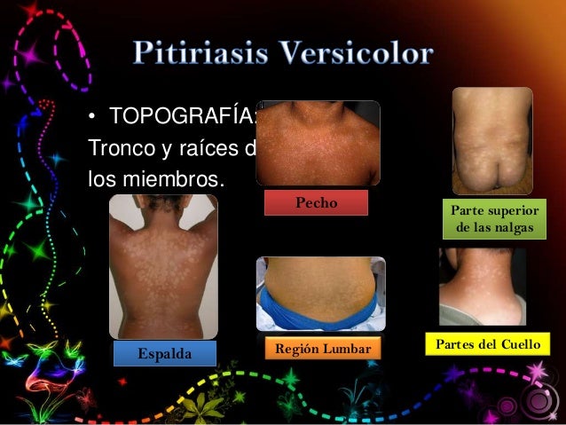 Pitiriasis Versicolor / Candidosis - Dermatología
