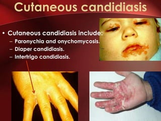 Candidiasis | PPTX