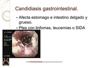 Candidiasis | PPT