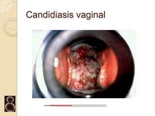 Candidiasis | PPT