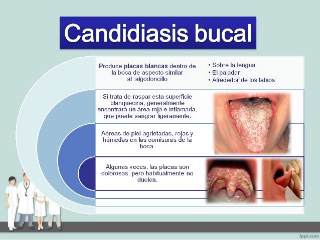 Que Causa La Candidiasis : Candidiasis oral – MOGO