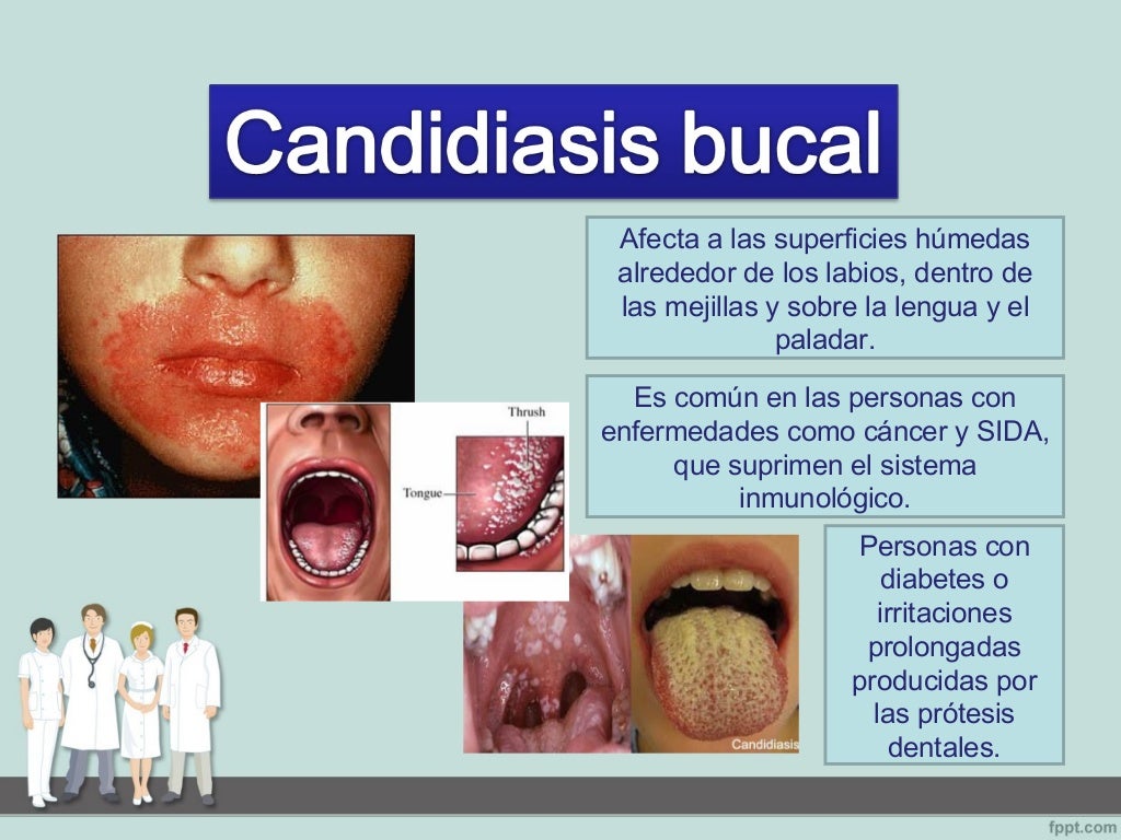 Candidiasis