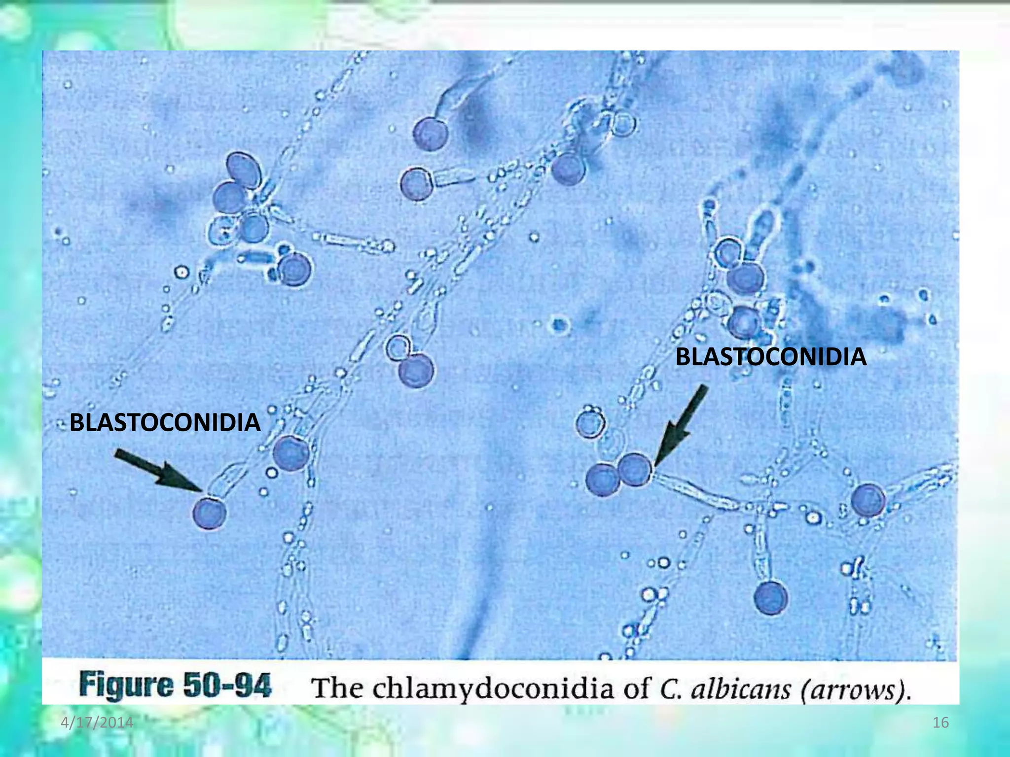Candidiasis, Moniliasis, Oral thrush, Yeast infections | PPTX