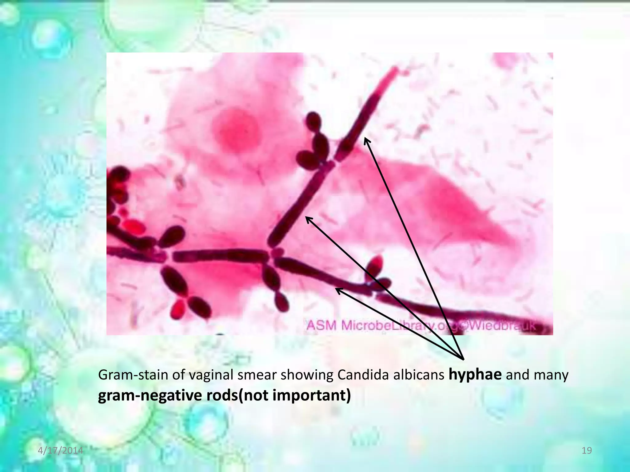 Candidiasis, Moniliasis, Oral thrush, Yeast infections | PPTX